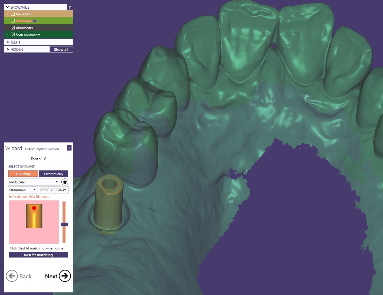 Titanium abutment met zirkonium kroon vanuit een volledig digitale workflow