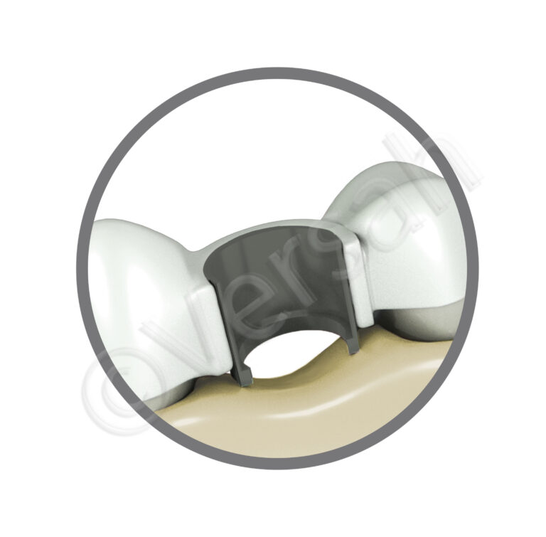 Versah Guided Surgery System: ultieme precisie bij osteotomieën